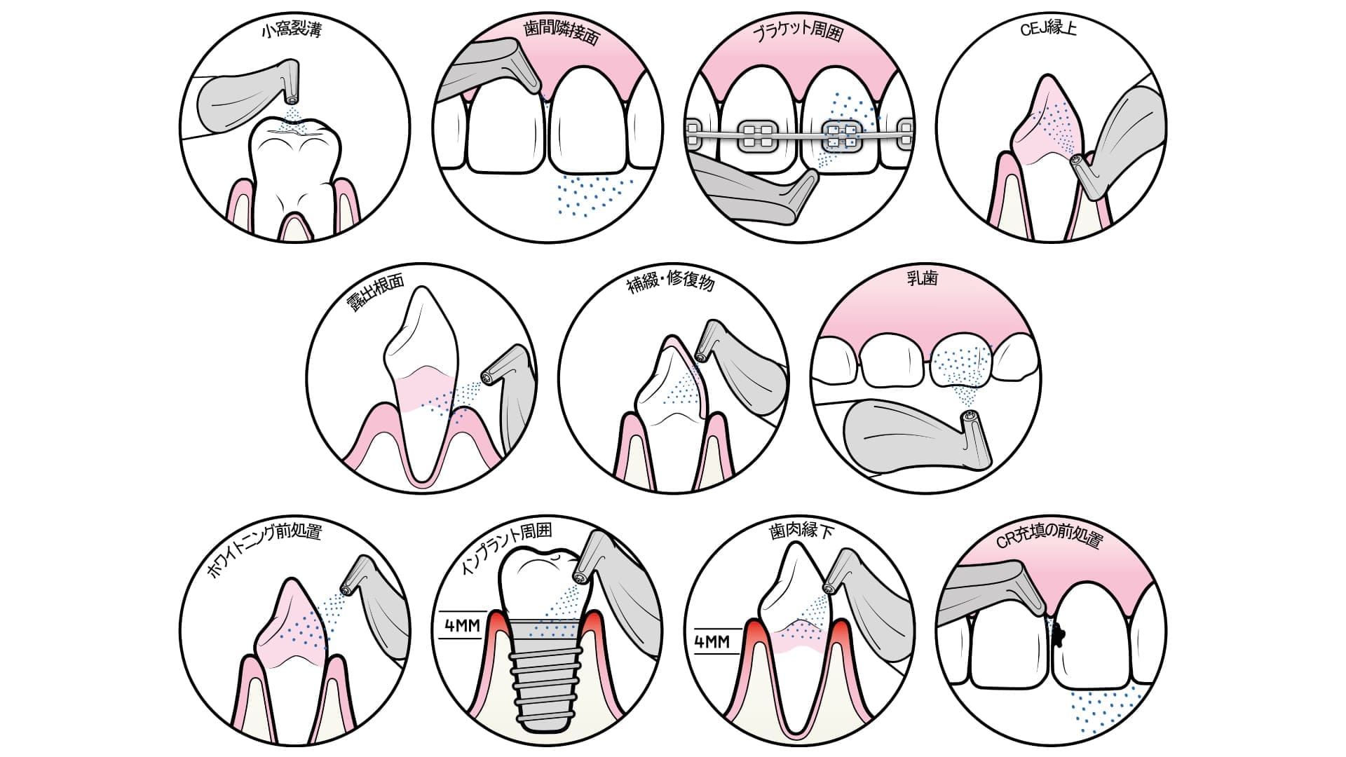 EMSを用いたGBT療法｜宮前区鷺沼の歯医者 アートデンタルクリニック鷺沼